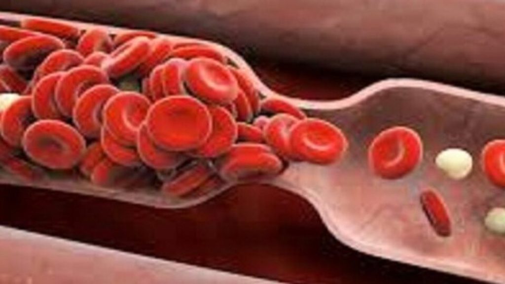 Světový den hemofilie: Za léčbu je ročně utraceno 68 miliónů. Jak se toto vzácné genetické ...